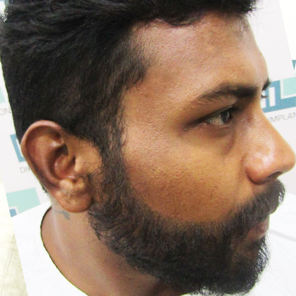 BEARD RESTORATION - DHI SRI LANKA